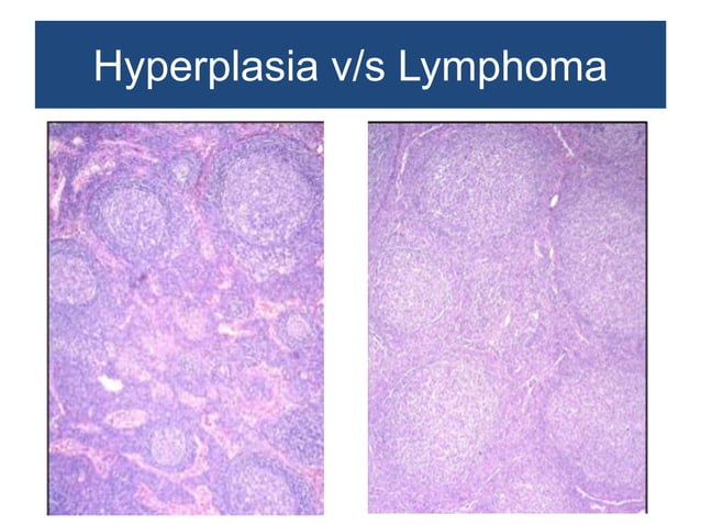 Non Neoplastic Lesions Of Lymph Node Pptx Blood Disorders
