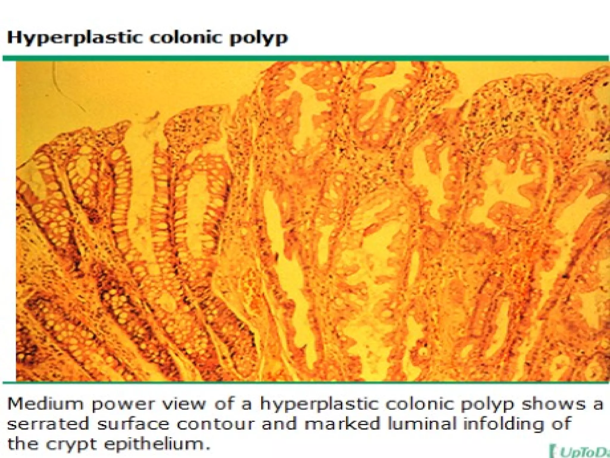 Non neoplasticColonic polyps | PPT