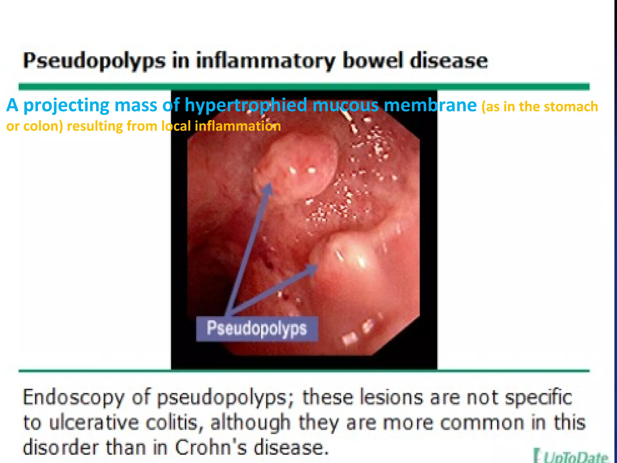 Non neoplasticColonic polyps | PPT