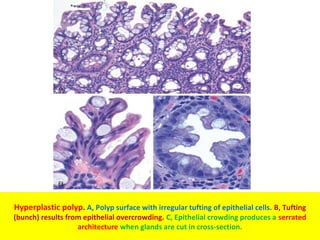 Non neoplasticColonic polyps | PPT