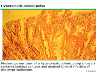 Non neoplasticColonic polyps | PPT