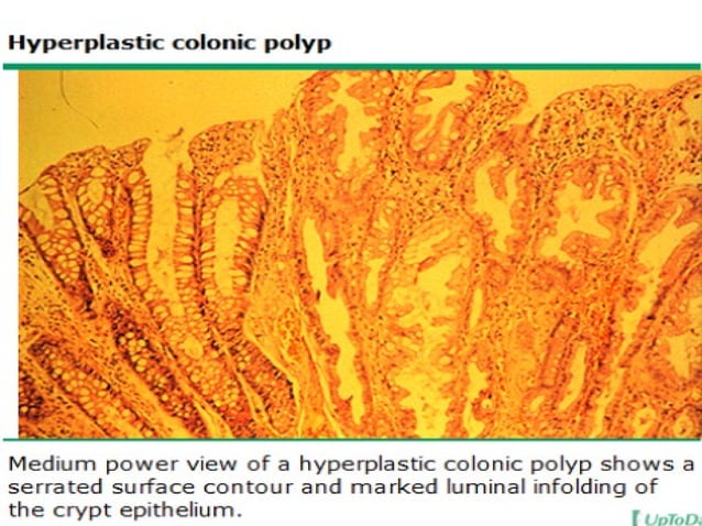 Non neoplasticColonic polyps | PPT | Digestive Disorders | Diseases and ...