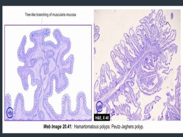 Non neoplasticColonic polyps | PPT | Digestive Disorders | Diseases and ...
