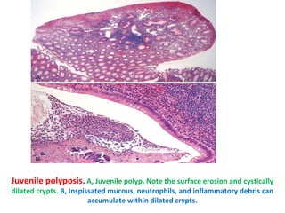 Non neoplasticColonic polyps | PPT