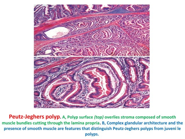 Non neoplasticColonic polyps | PPT | Digestive Disorders | Diseases and ...
