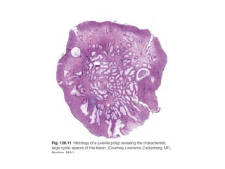 NON-NEOPLASTIC POLYPS AND POLYPOID LESIONS .pptx