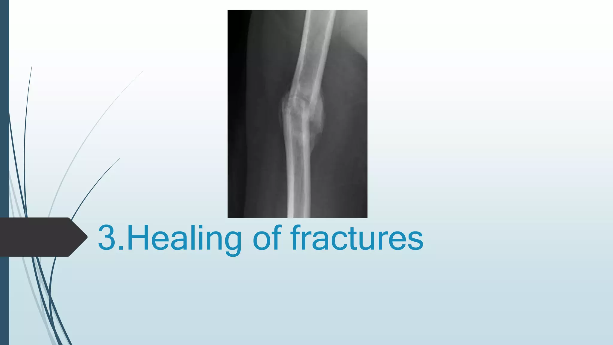 Non operative management of fractures | PPTX