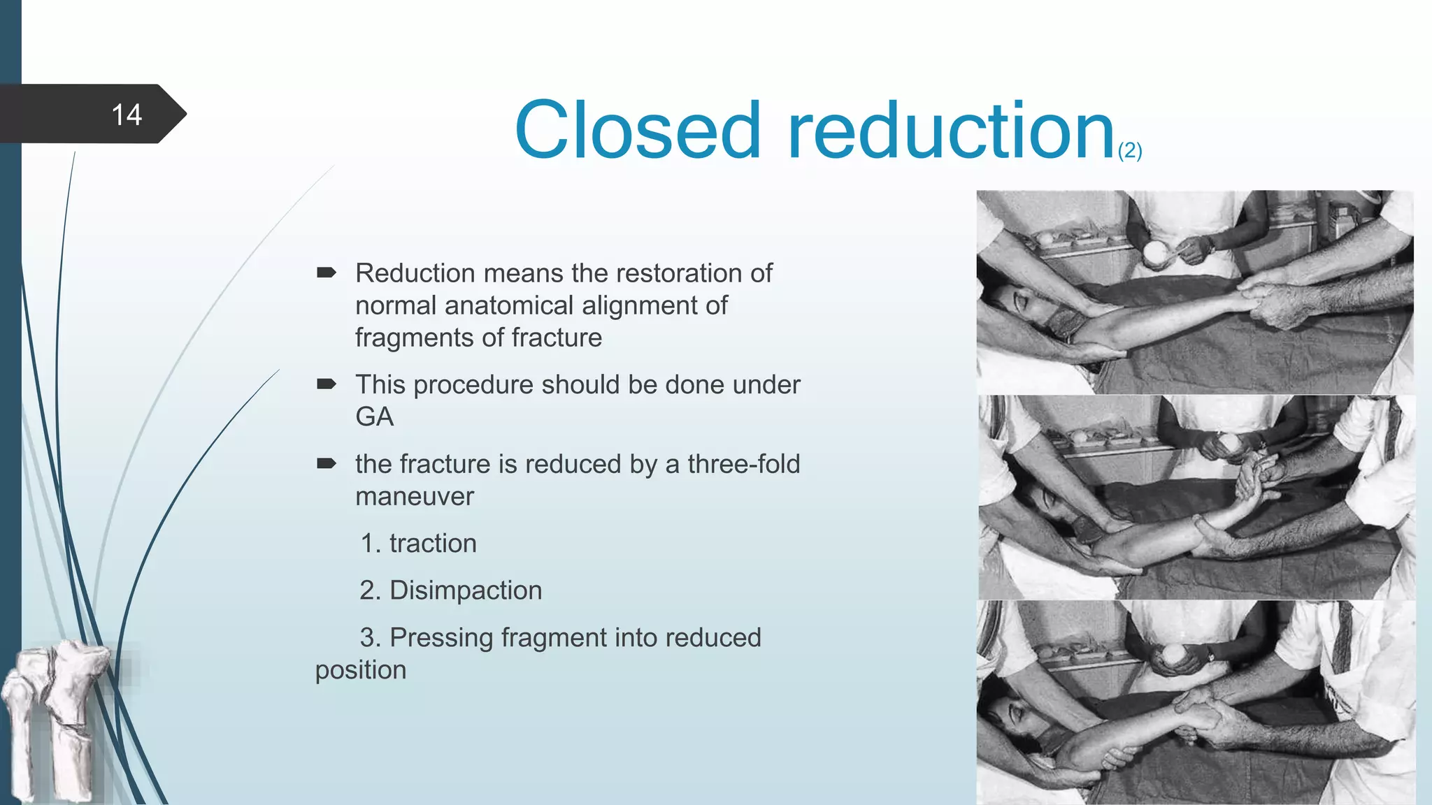 Non operative management of fractures | PPTX