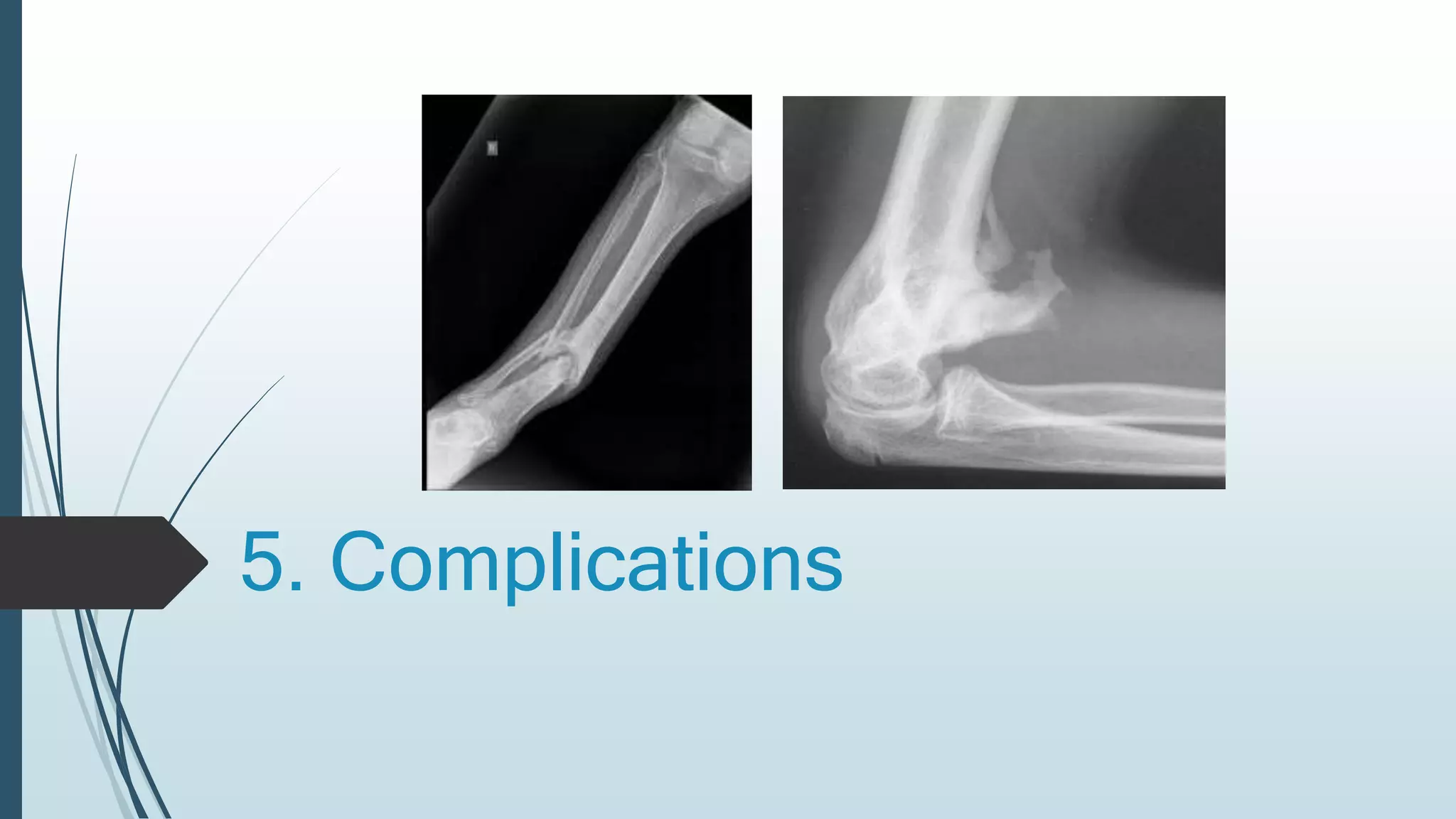 Non operative management of fractures | PPTX