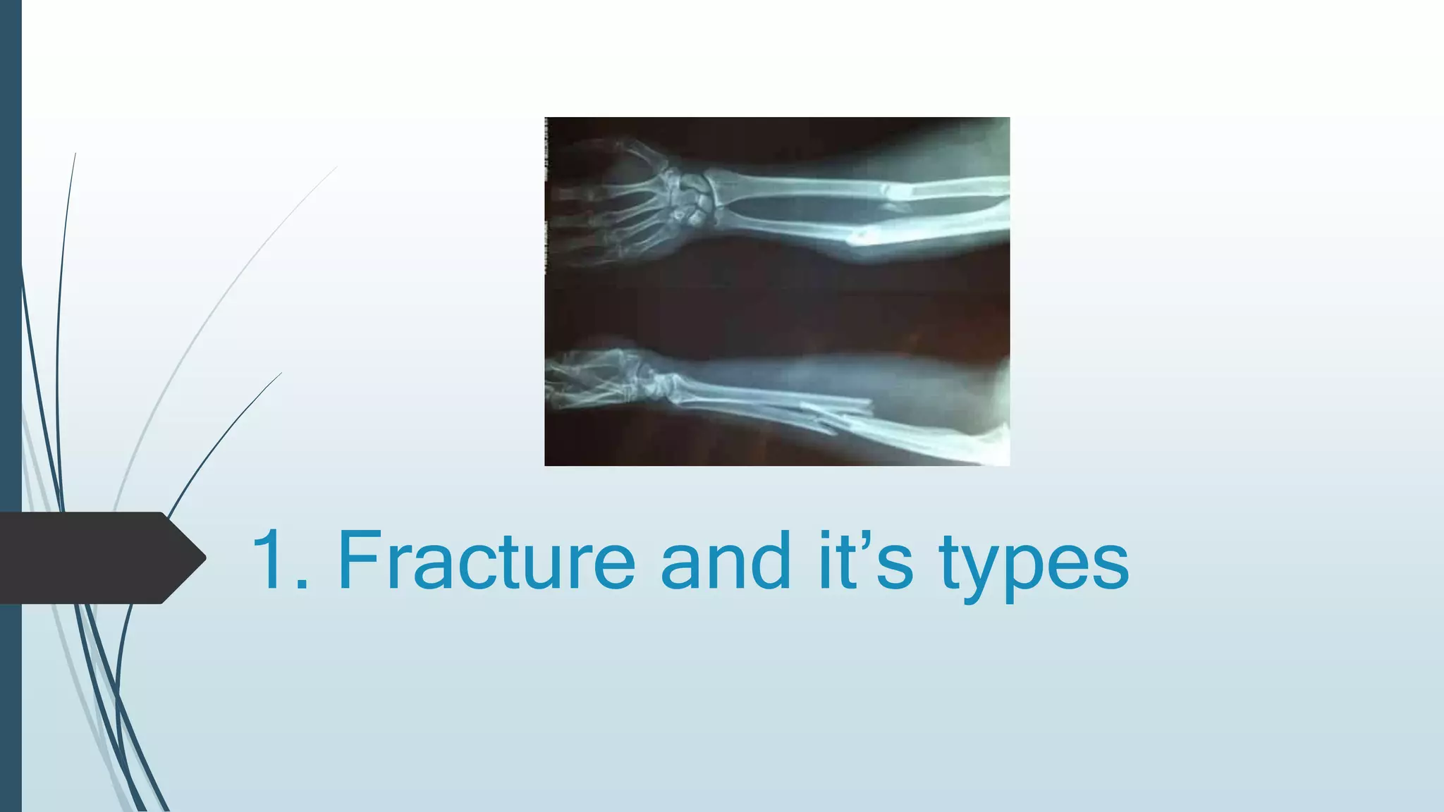 Non operative management of fractures | PPTX