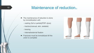 Non operative management of fractures | PPTX