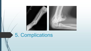 Non operative management of fractures | PPTX