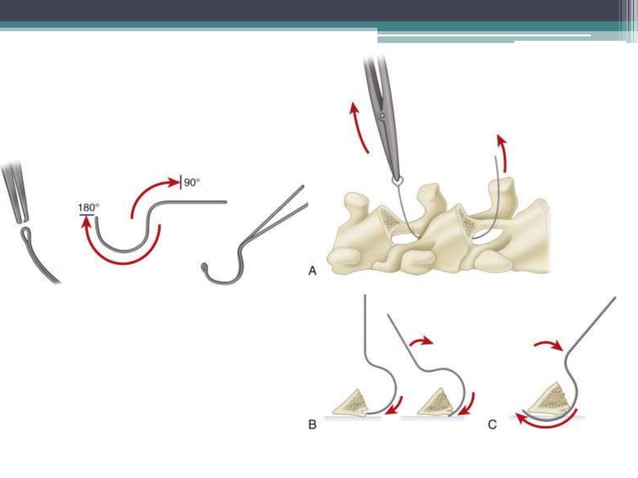 Non pedicular fixation techniques for the treatment of spine | PPT