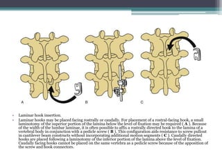 Non pedicular fixation techniques for the treatment of spine | PPTX