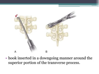 Non pedicular fixation techniques for the treatment of spine | PPTX