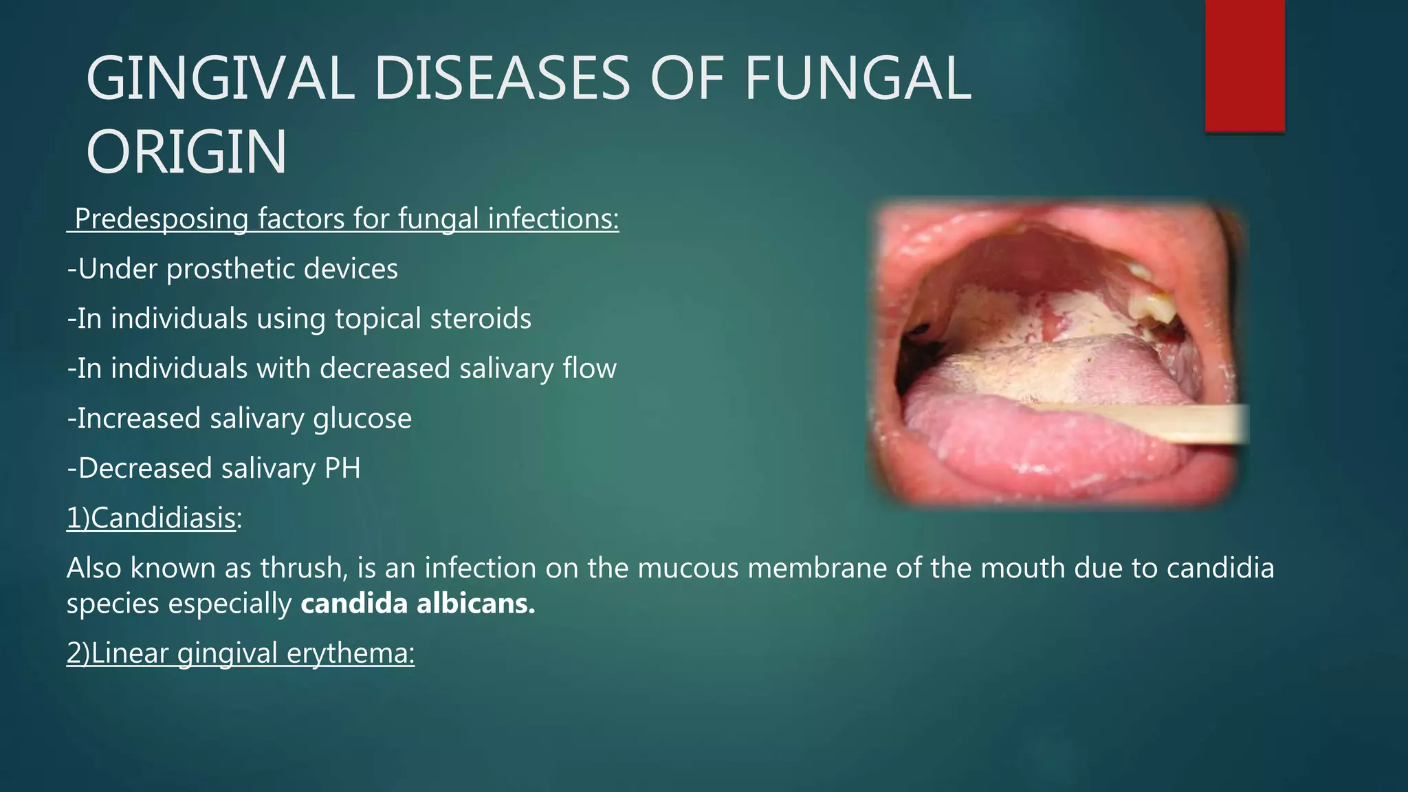 Non plaque induced gingival diseases | PPTX