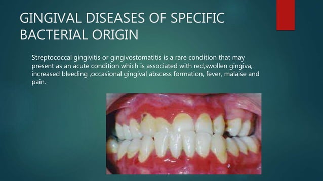 Non plaque induced gingival diseases | PPTX | Dental Health | Diseases ...
