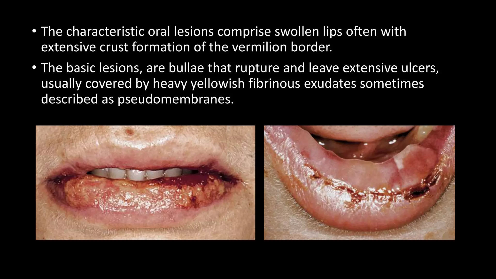 Non plaque induced gingivitis | PPTX