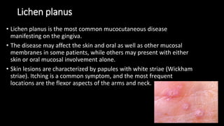 Non plaque induced gingivitis | PPTX