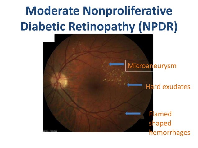 Non proliferative diabetic retinopathy by phaneendra akana | PPT