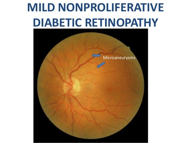 Non proliferative diabetic retinopathy by phaneendra akana