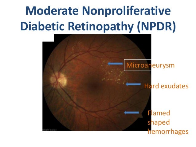 Non proliferative diabetic retinopathy by phaneendra akana
