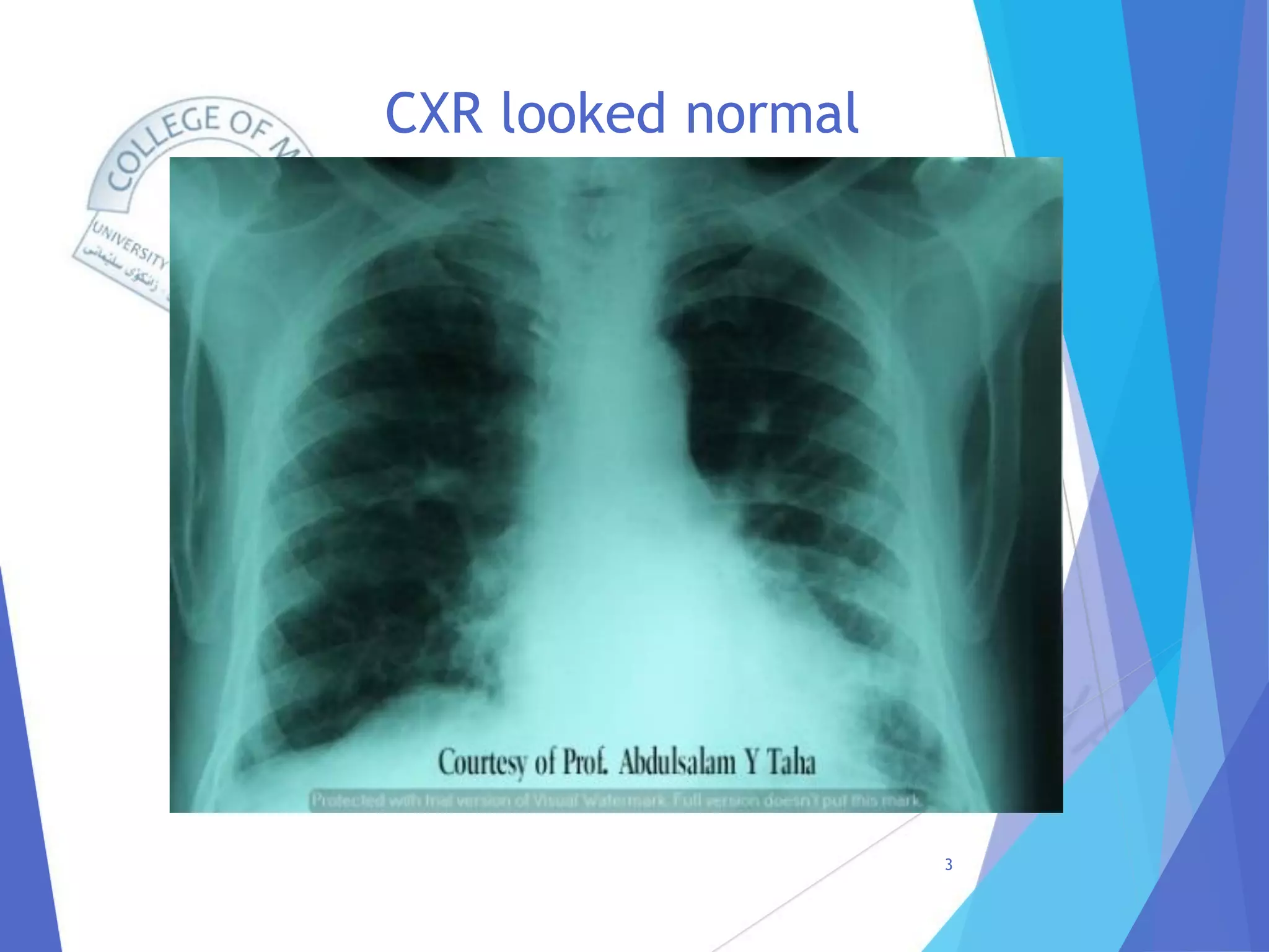 Non-resolving cough with normal bronchoscopy.pdf