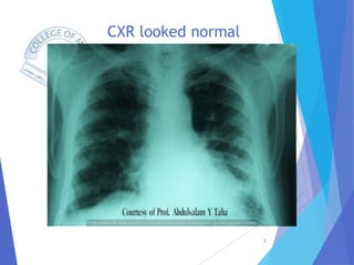 Non-resolving cough with normal bronchoscopy.pdf