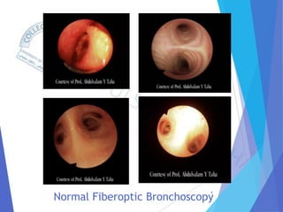 Normal Bronchoscopy