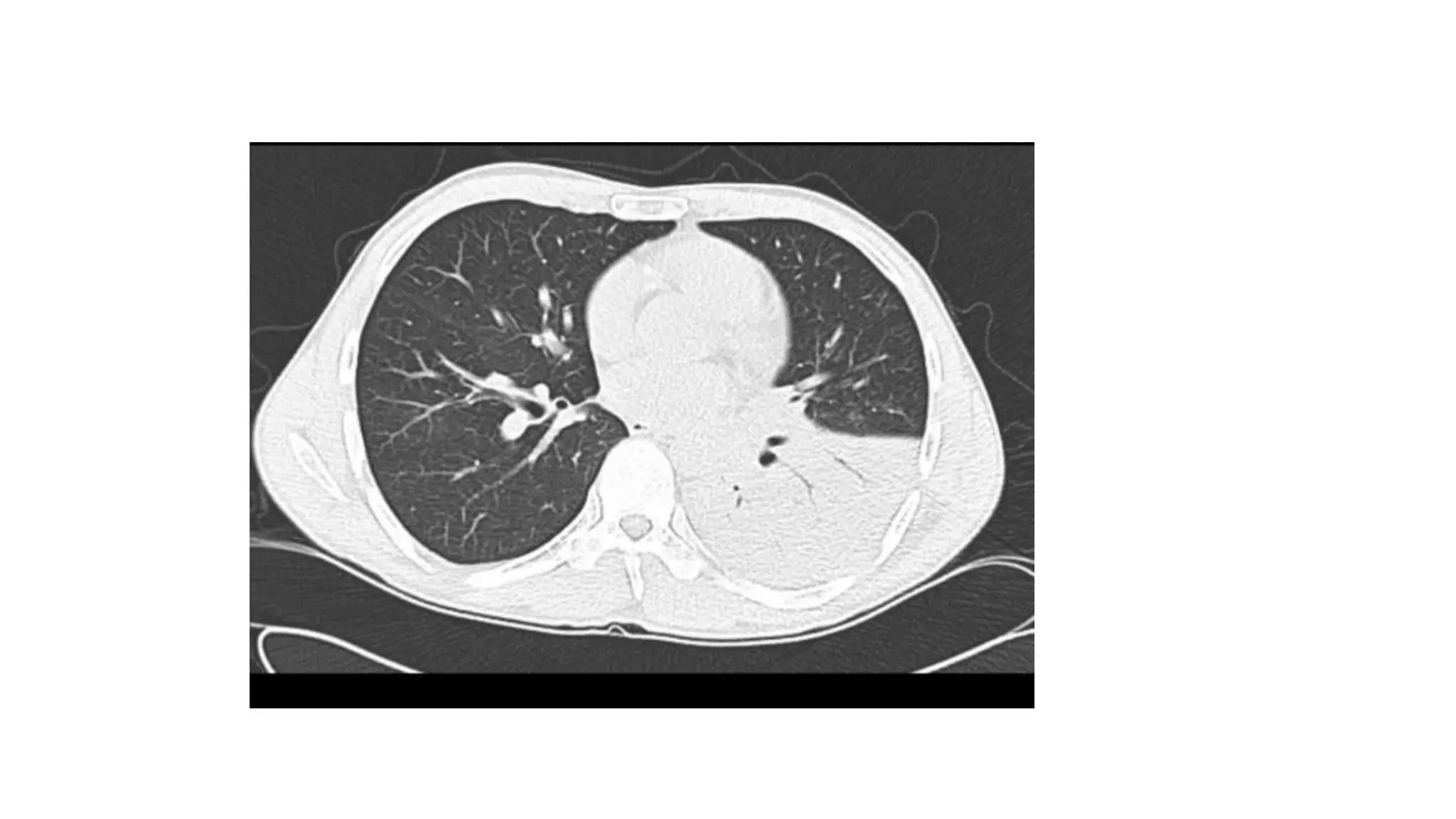 NON-RESOLVING PNEUMONIA.pptx