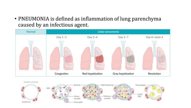 NON-RESOLVING PNEUMONIA.pptx