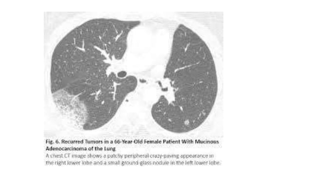 NON-RESOLVING PNEUMONIA.pptx