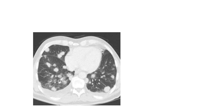 NON-RESOLVING PNEUMONIA.pptx