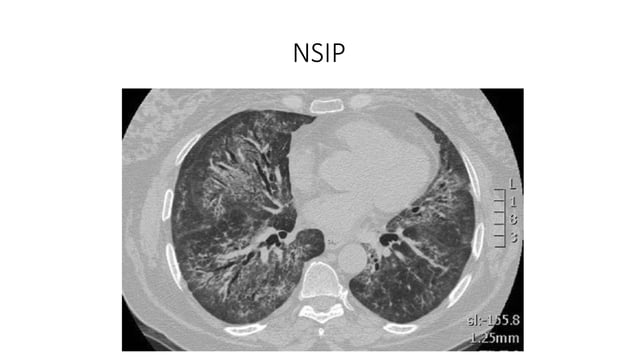NON-RESOLVING PNEUMONIA.pptx