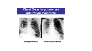 NON-RESOLVING PNEUMONIA.pptx
