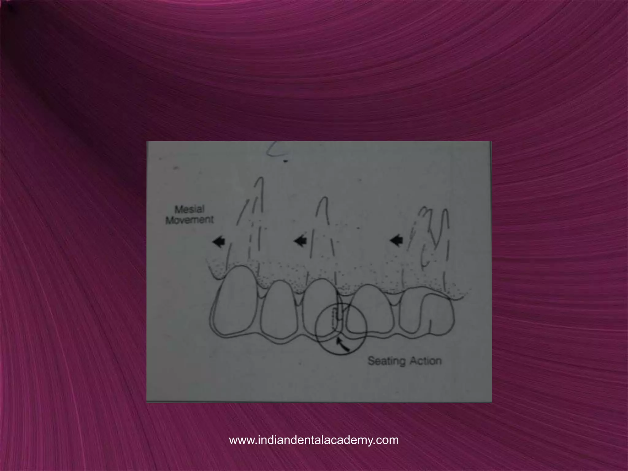 Non rigid connectors in fixed prosthesis / cosmetic dentistry training ...