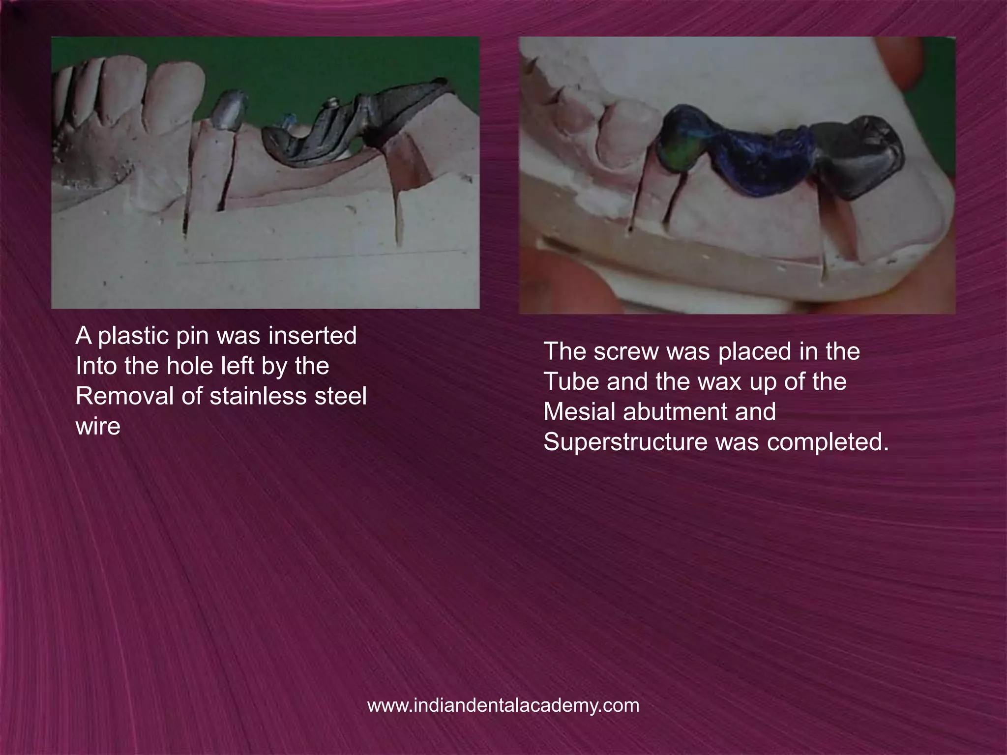 Non rigid connectors in fixed prosthesis / cosmetic dentistry training ...