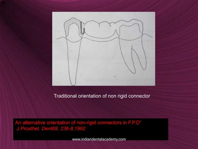 Non rigid connectors in fixed prosthesis / cosmetic dentistry training