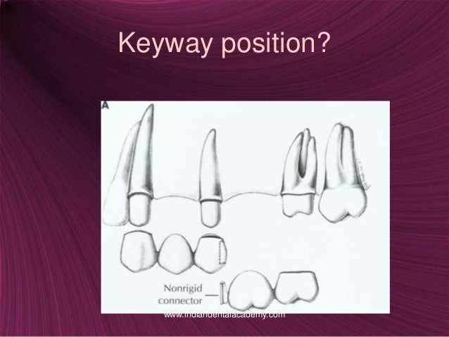 Non rigid connectors in fixed prosthesis / cosmetic dentistry training