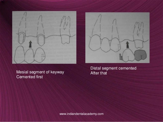 Non rigid connectors in fixed prosthesis / cosmetic dentistry training