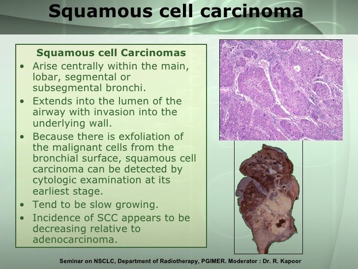 Non Small Cell Lung Cancer