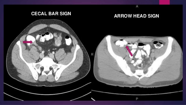 Non surgical mimics of appendicitis on imaging