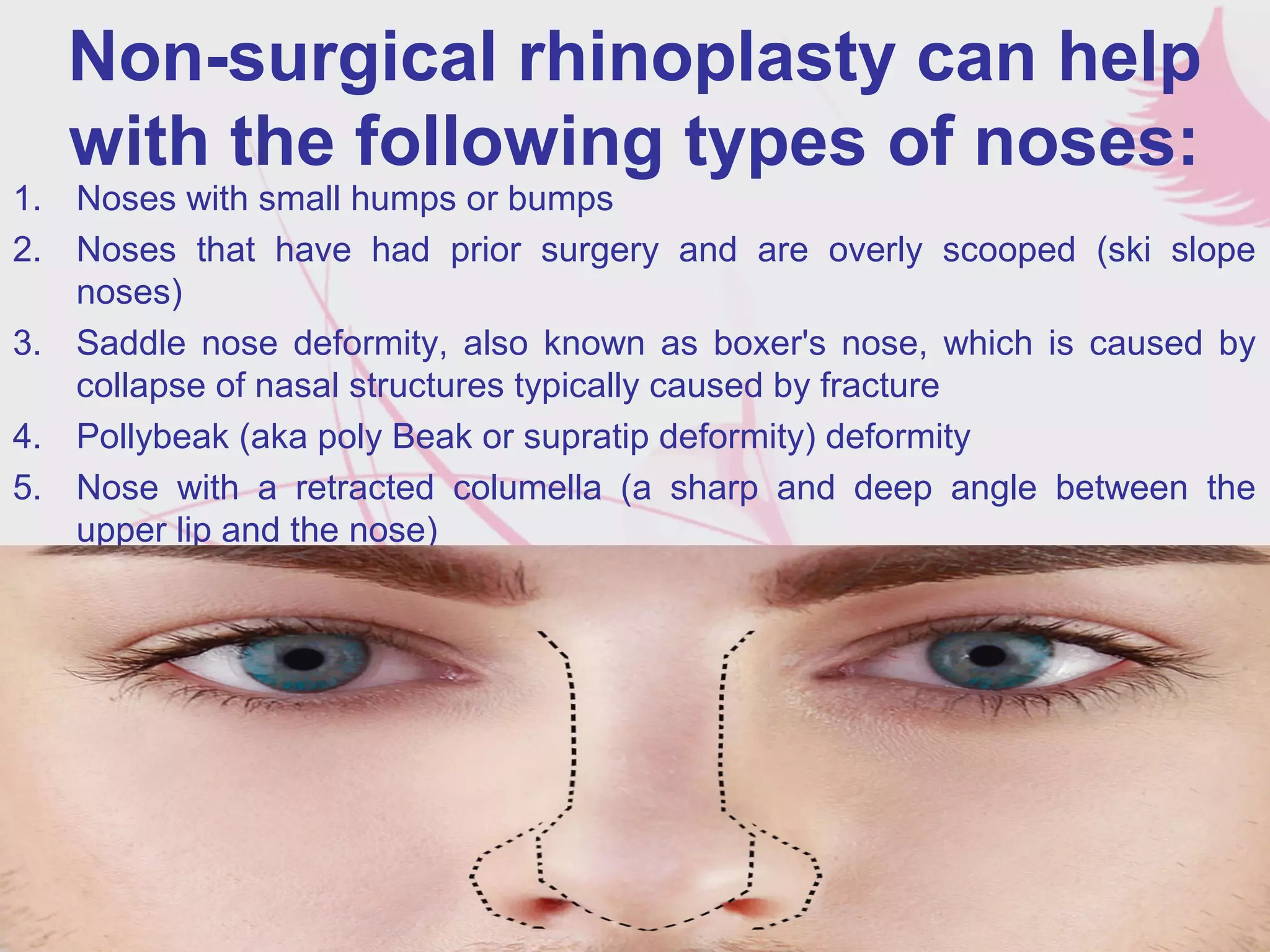Non Surgical Nose Job | PPT