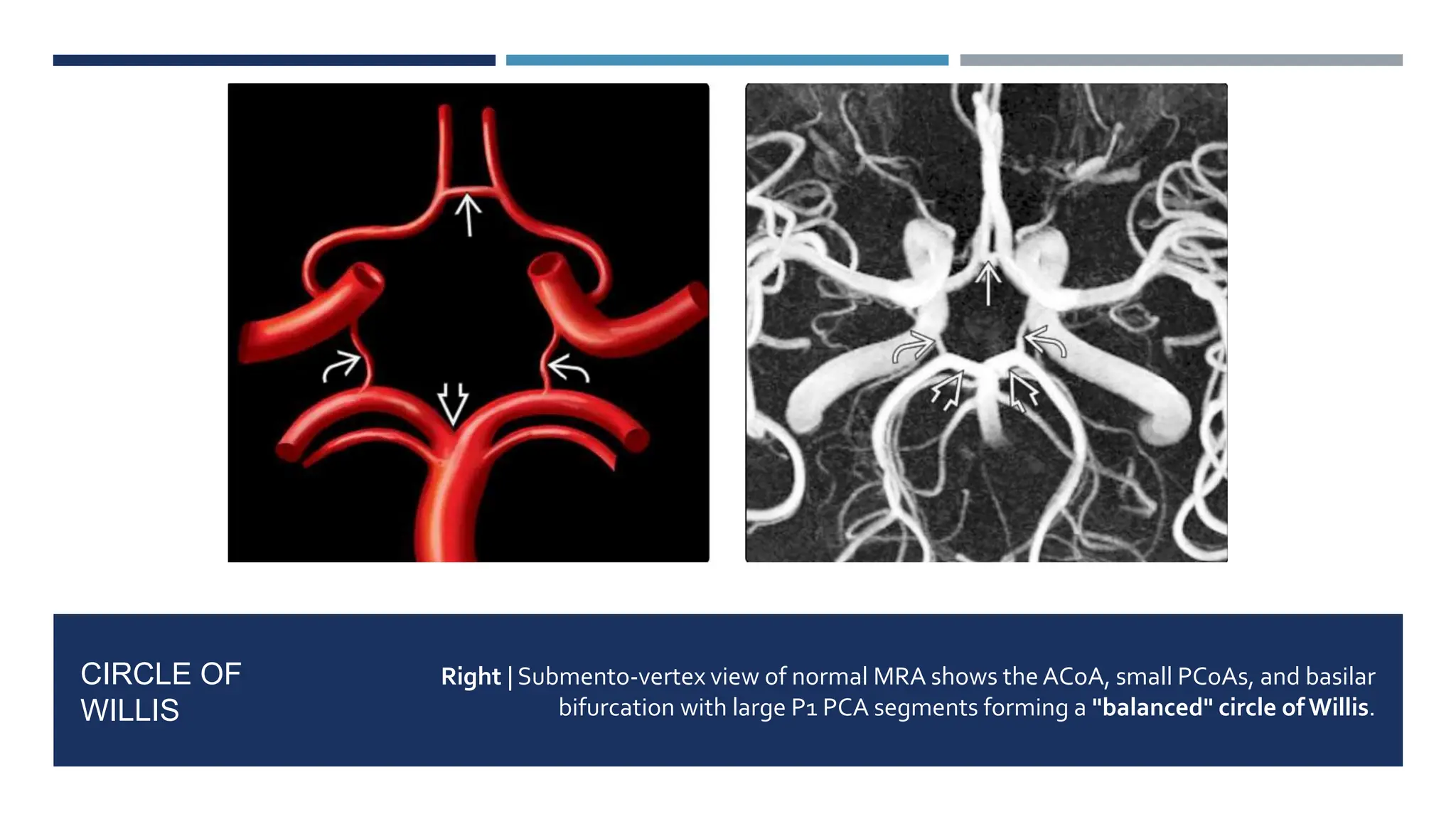 Non-traumatic Vasculogenic Lesions of the Brain | PPTX