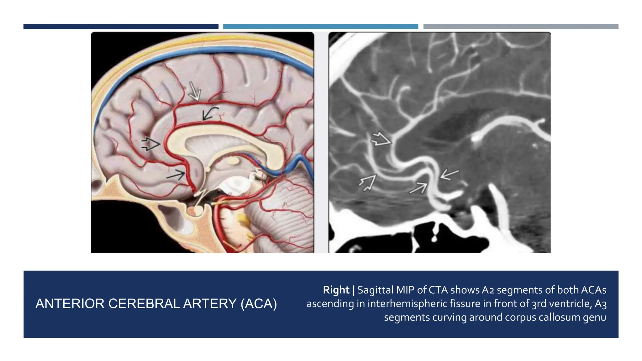 Non-traumatic Vasculogenic Lesions of the Brain | PPTX