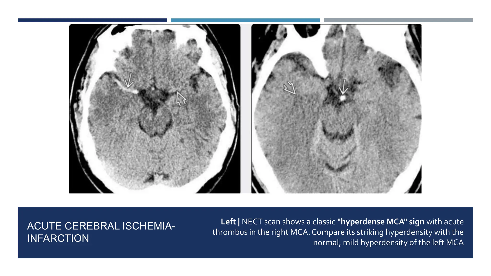 Non-traumatic Vasculogenic Lesions of the Brain | PPTX