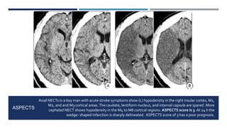 Non-traumatic Vasculogenic Lesions of the Brain | PPTX