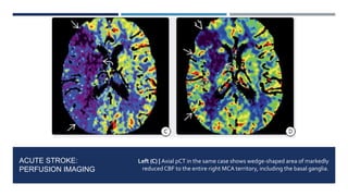 Non-traumatic Vasculogenic Lesions of the Brain | PPTX