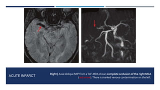 Non-traumatic Vasculogenic Lesions of the Brain | PPTX