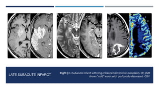 Non-traumatic Vasculogenic Lesions of the Brain | PPTX